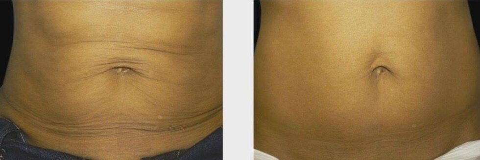 Exilis Elite - Sculptbody